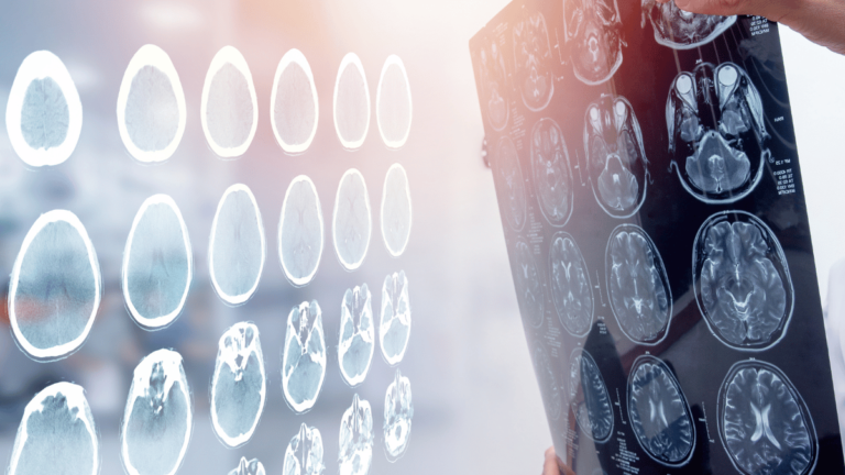 Esclerosis Múltiple: ¿Qué es?, Síntomas y Tratamiento – Puerto Rico ...